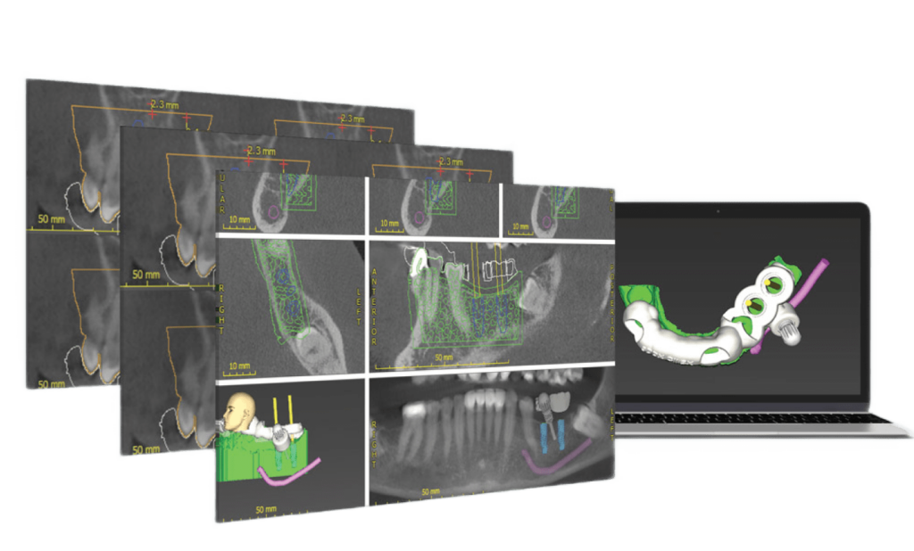 Implant Planning - 3DDX