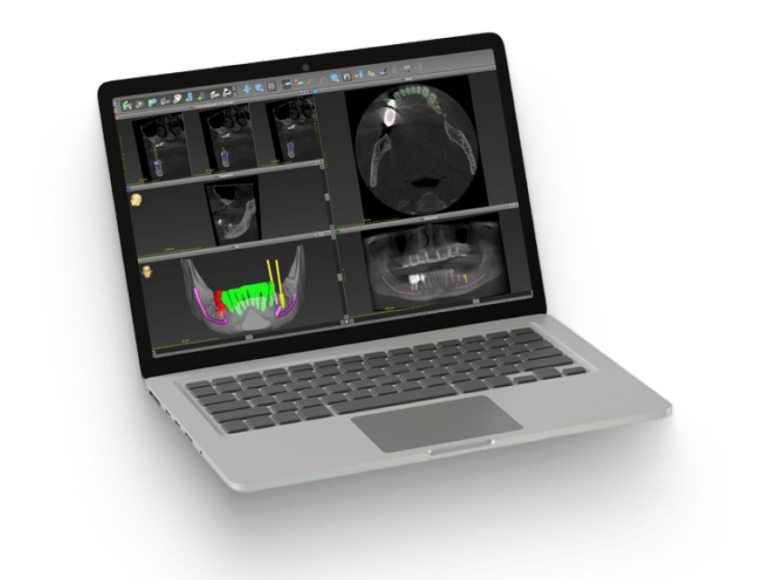 Implant Planning Software - 3DDX
