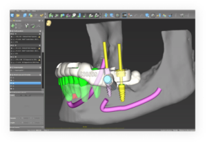 Implant Planning Software - 3DDX
