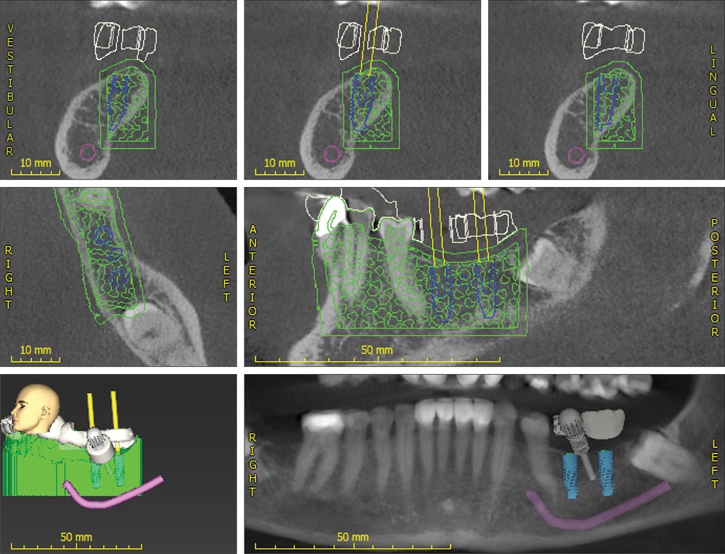 Implant Planning Software - 3DDX