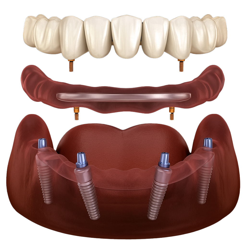 All-on-X vs All-on-4: Key Differences in Full-Arch Implantology - 3DDX