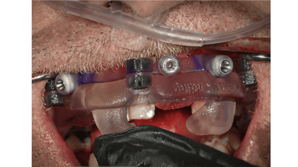 All-on-X: A Complete Guide to Full Arch Guided Surgery - 3DDX