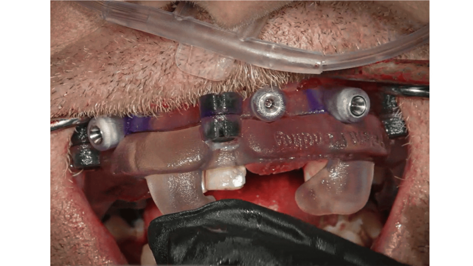 All-on-X: A Complete Guide to Full Arch Guided Surgery - 3DDX