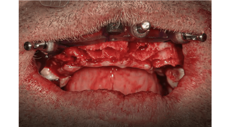 All-on-X: A Complete Guide to Full Arch Guided Surgery - 3DDX