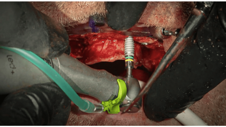 All-on-X: A Complete Guide to Full Arch Guided Surgery - 3DDX