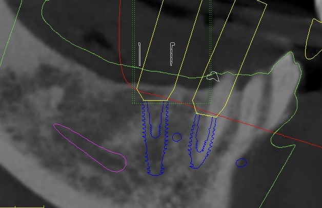 All-on-X: A Complete Guide to Full Arch Guided Surgery - 3DDX