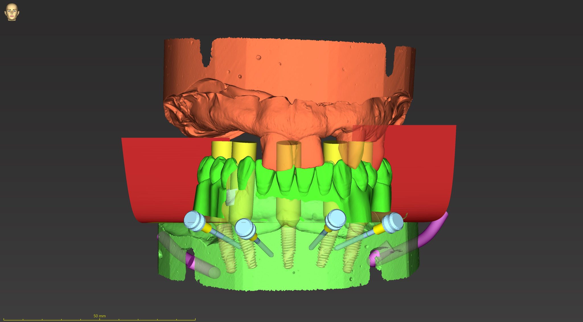 All-on-X: A Complete Guide to Full Arch Guided Surgery - 3DDX