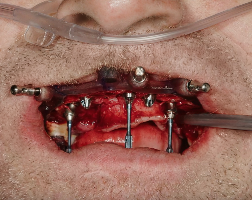 All-on-X: A Complete Guide to Full Arch Guided Surgery - 3DDX