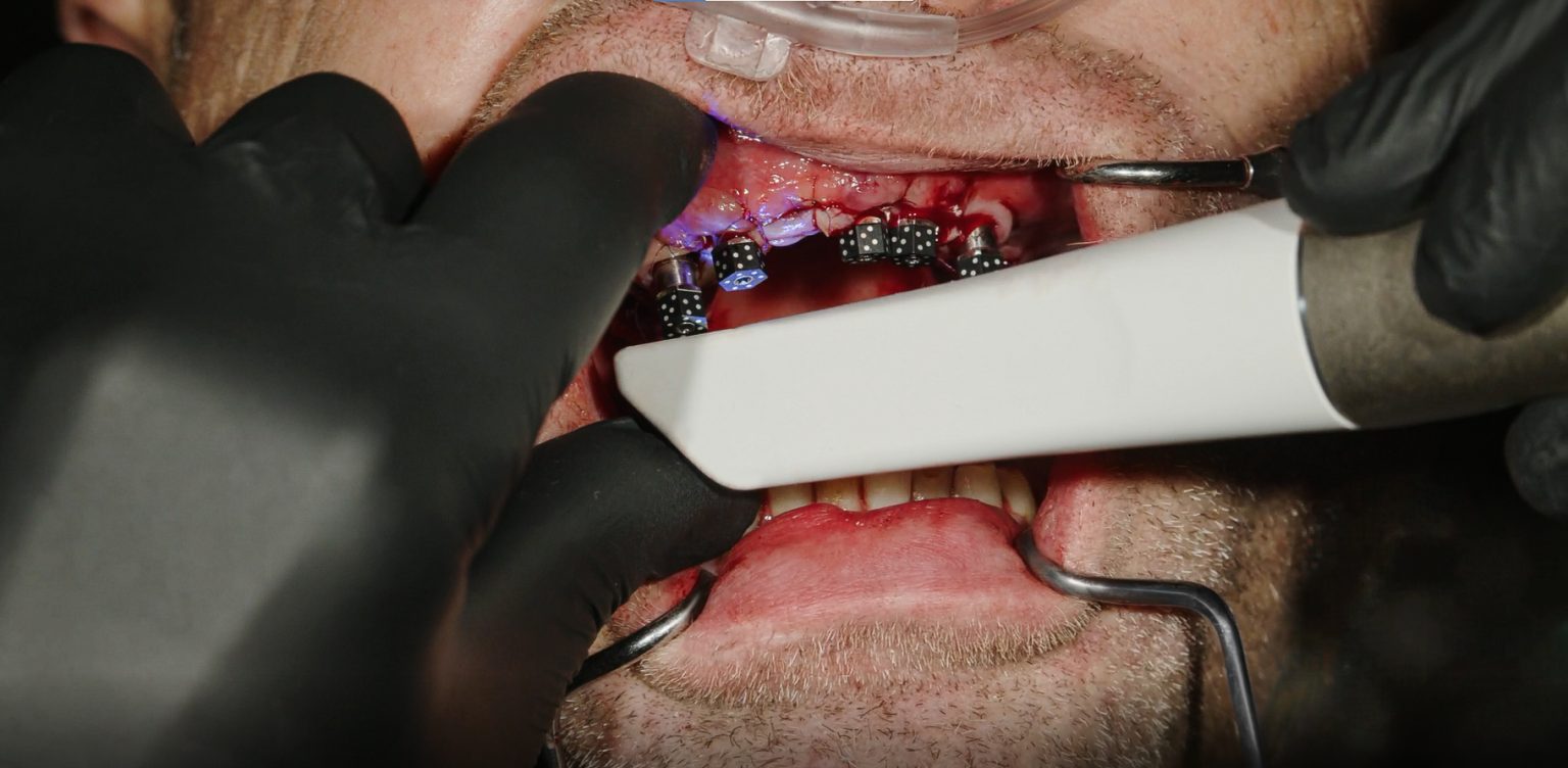 How Photogrammetry Is Transforming Full-Arch Implant Workflows with 3DDX - 3DDX